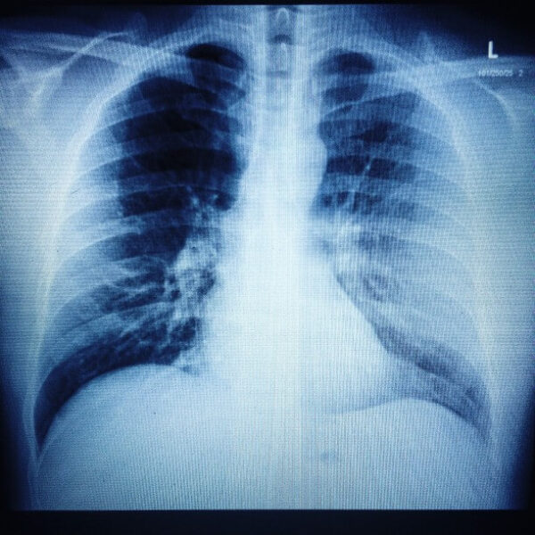 Respiratory Pathogen Panel - Clarity Labs